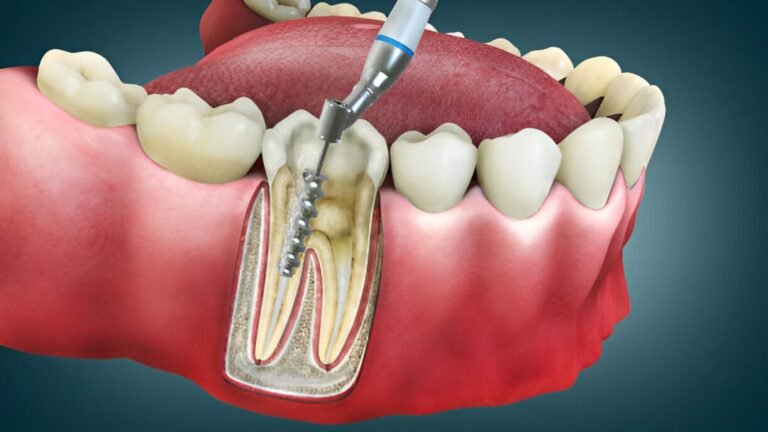 Dental Root Canal Procedure: Everything You Must Know
