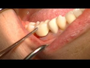 Dental Crown Removal: Everything You Need to Know